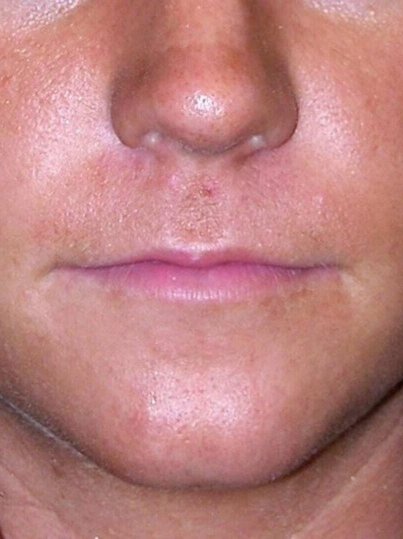 Lip Lift | Cleveland Cosmetic Surgery