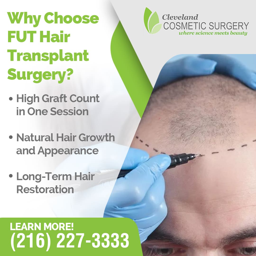 FUT Hair Transplant Surgery: Restoring Hairline Permanently | Cleveland ...